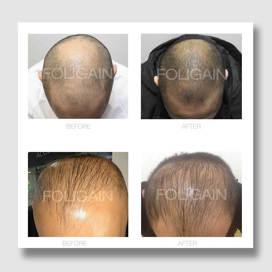 Unlocking The Secrets of Minoxidil for Hair Restoration | FOLIGAIN EUROPE Unlocking The Secrets of Minoxidil for Hair Restoration | FOLIGAIN EUROPE